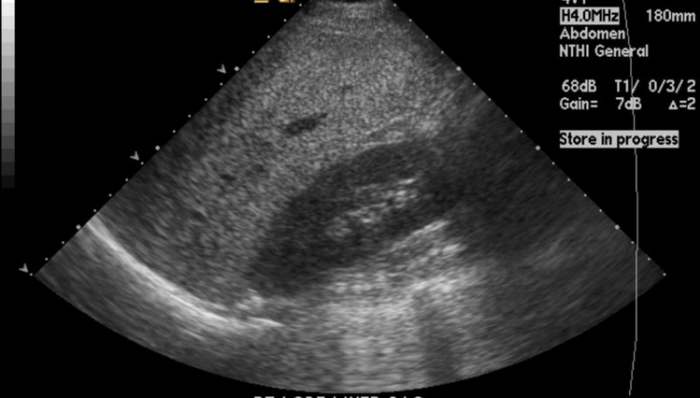 Prirodni lek za masnu jetru - kako se leči masna jetra